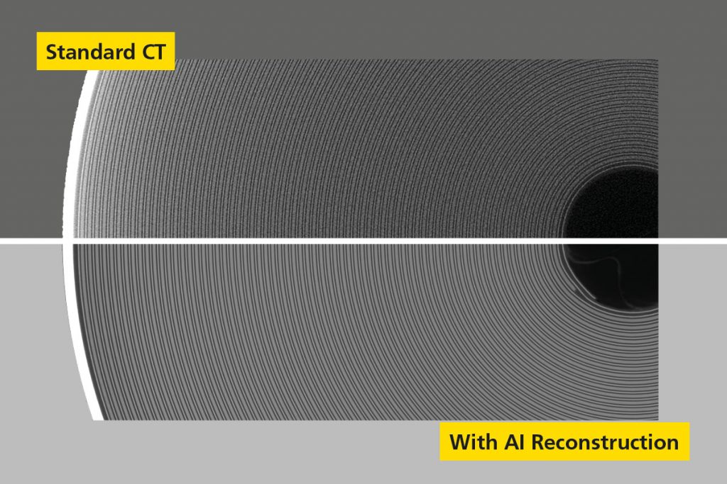 AI Reconstruction Uses Deep Learning To Deliver Faster and Clearer CT ...